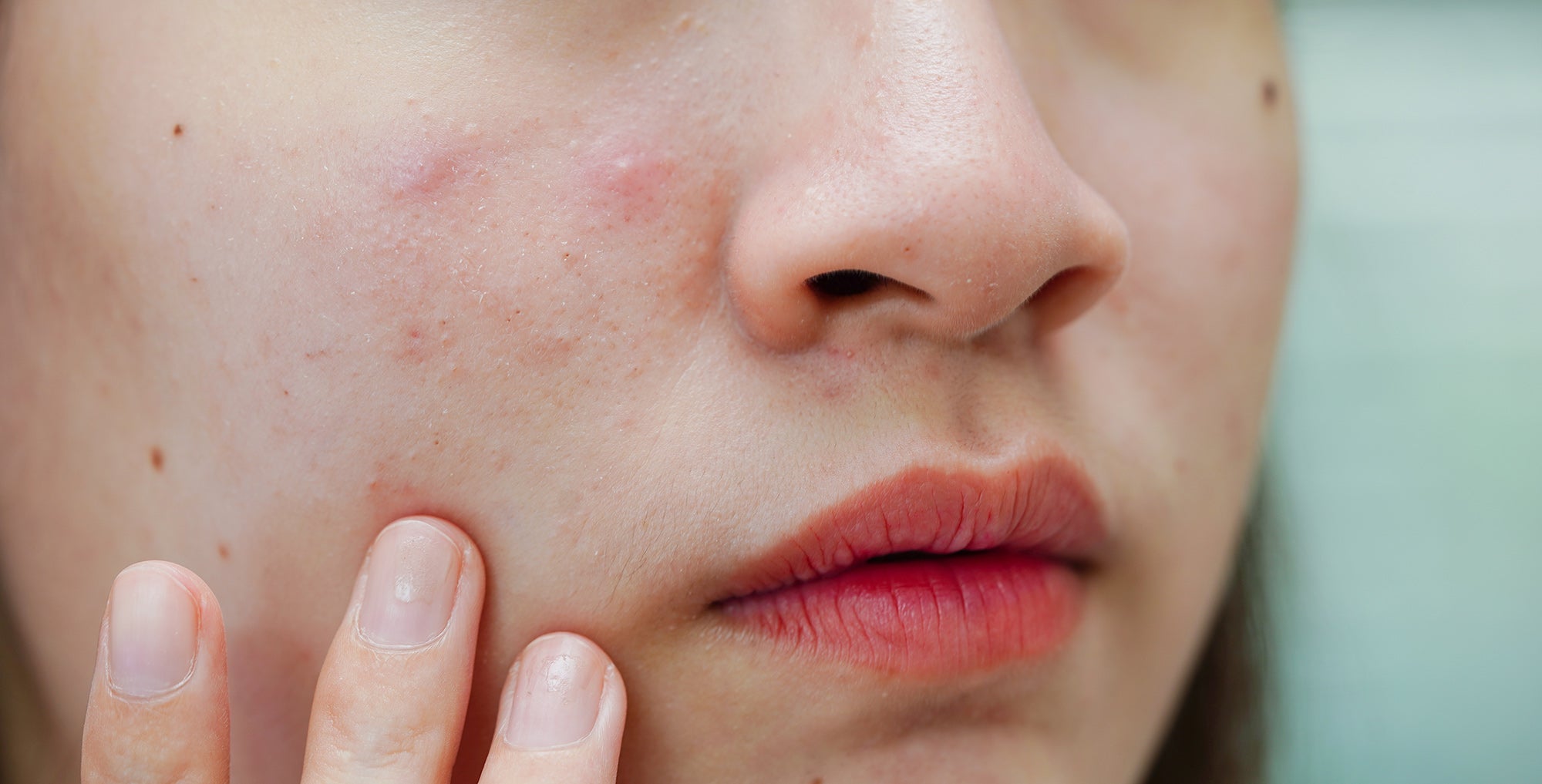 Dry Skin and Acne: The Unexpected Connection You Need to Know