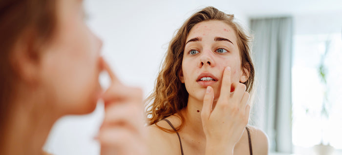 How to Prevent Acne: 14 Tips to Reduce Pimples | allmedic