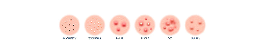 What’s the Difference Between Acne and Pimples?